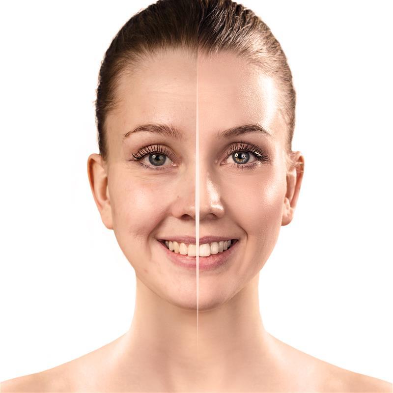 Neovie - RF Microneedling - Technologies