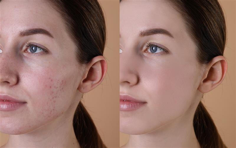 Neovie - Face Experiences - Skin Scars